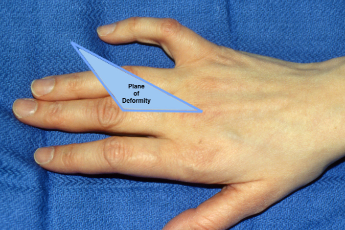 CLINODACTYLY | Hand Surgery Resource